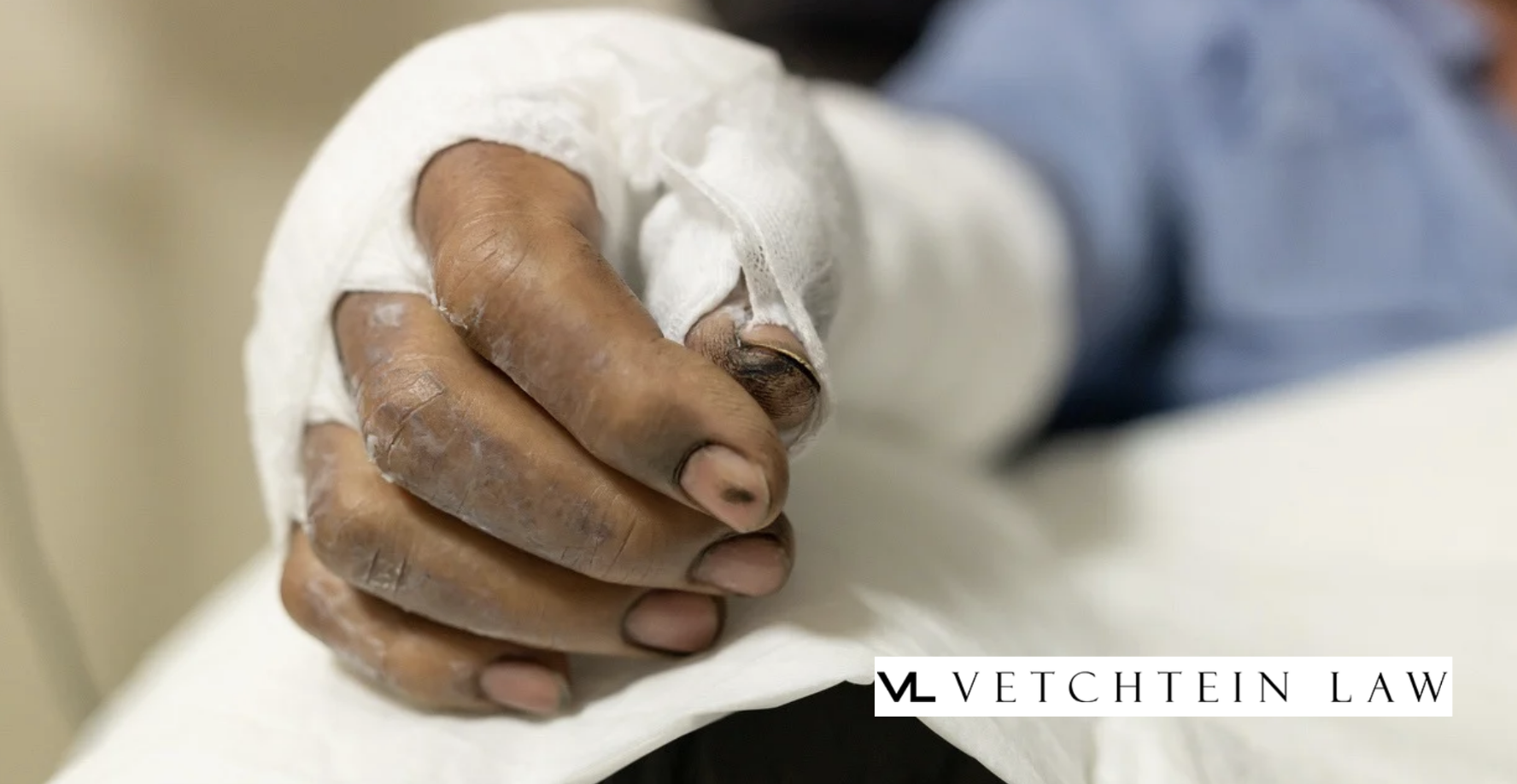 How Are Burn Injuries Catastrophic?